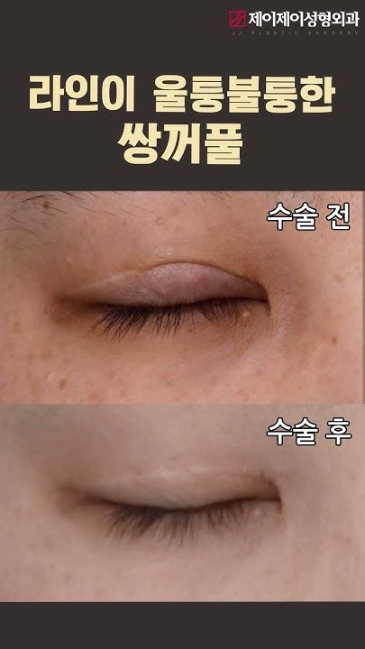 [전후영상] 라인이 울퉁불퉁한 쌍꺼풀 눈 성형 영상 제이제이성형외과 Shorts Youtube