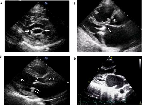 Recommendations For The Use Of Echocardiography In The Evaluation Of