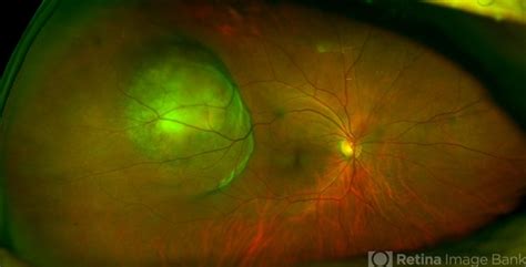 Chroroidal Melanoma Retina Image Bank Chroroidal Melanoma Retina Image Bank