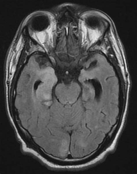 Neurosyphilis Masquerading As Autoimmune Encephalitis Practical Neurology