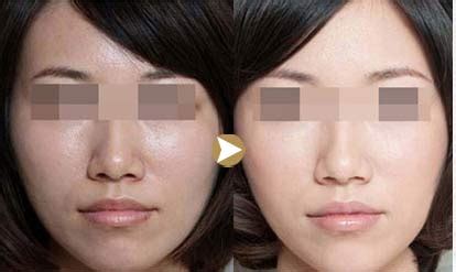 北京皮肤美白 怎样美白皮肤 北京皮肤美白价格 Yestar艺星整形美容医院