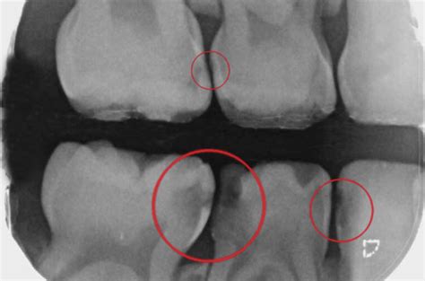 Caries Interproximal Qué Es Causas Y Cómo Tratarla De Forma Efectiva