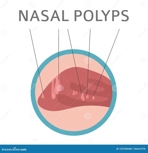 Nasal Diseases Nasal Polyps Causes Diagnosis And Treatment Medical Infographic Design Stock