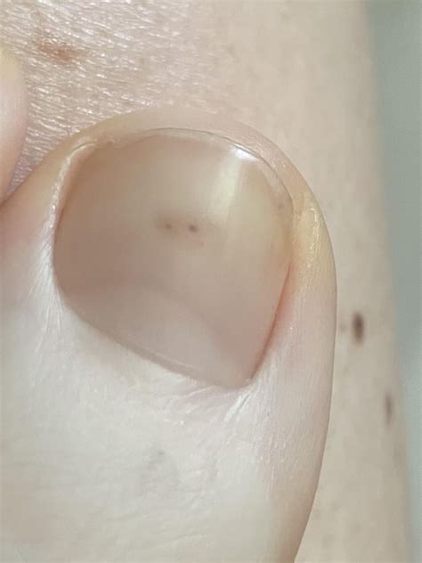 Brown Spots On Toenail Appeared Randomly Is It Melanoma R
