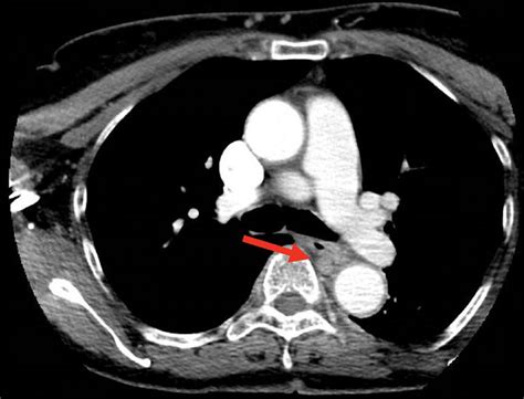 Ct Neck With Contrast Demonstrates A Mass Compressing The Esophagus At