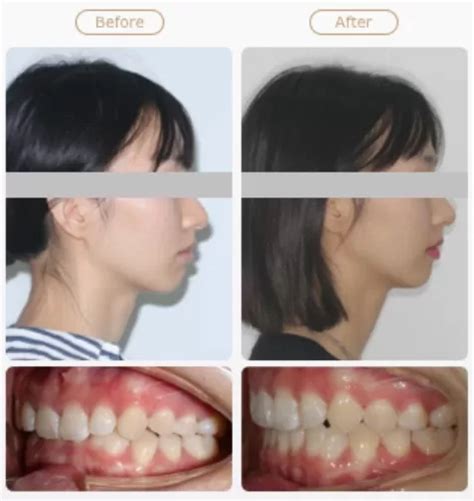Anterior Teeth Protrusion Shanghai Smartee Denti Technology Co Ltd