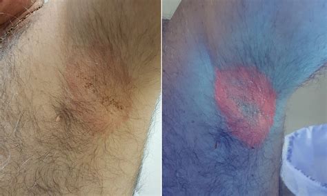 Erythrasma Corynebacterium Minutissimum Frequently