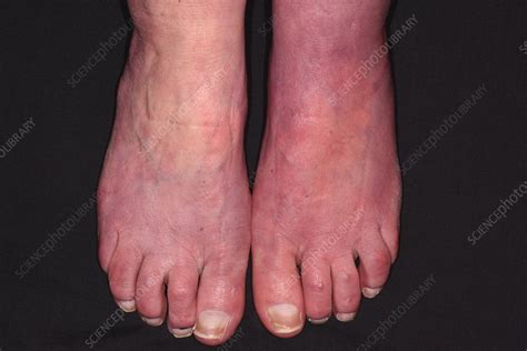 Peripheral Vascular Disease Stock Image C0549388 Science Photo