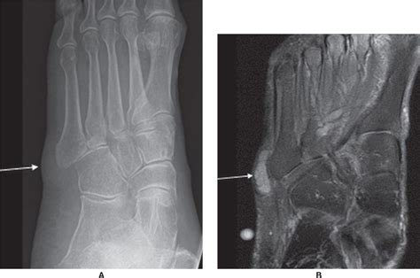 25 Magnetic Resonance Imaging Of Foot And Ankle Pathology
