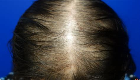 Female Pattern Alopecia Osei Tutu Dermatology And Hair Restoration