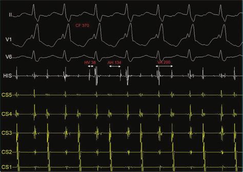 Tachycardia With A Right Bundle Branch Block Morphology From Top To Download Scientific
