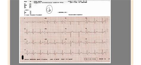 Early 30s 1 Syncope 3 Near In Last 2 Years Pvcs The Last Few Weeks