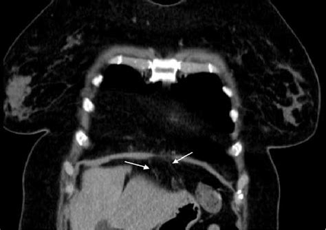 Sagittal Reformatted CT Scan Curvilinear Densities Originating From Download Scientific