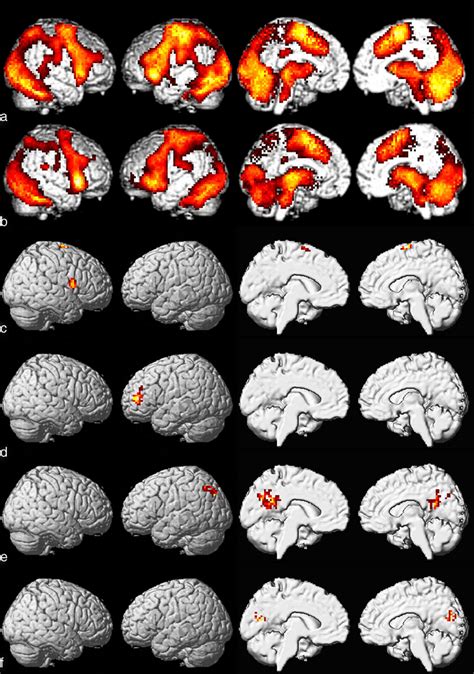 Surface Rendered Images Of Cerebral Activation During Verbal Retrieval