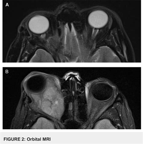 Figure 2 From An Orbital Malignant Melanoma Arising In Cellular Blue Nevus In A Patient With