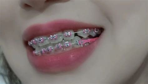 Bold And Beautiful Eye Catching Braces Color Ideas Healthy