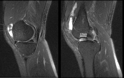 Articular Cartilage Defects Of Knee Knee And Sports Orthobullets