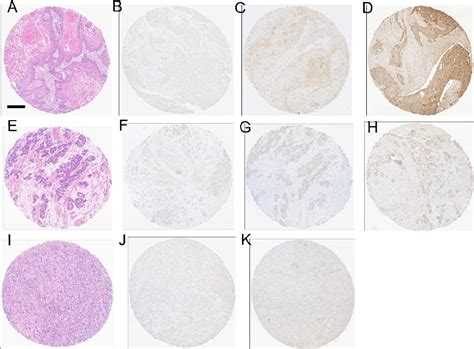 Figure 1 From Expression Of Nectin 4 In Variant Histologies Of Bladder Cancer And Its Prognostic