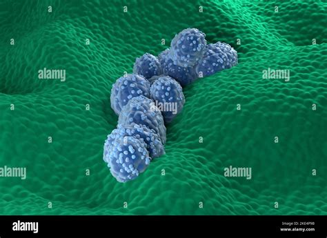 Prostate Cancer Cells In The Prostatic Glandular Epithelium Front