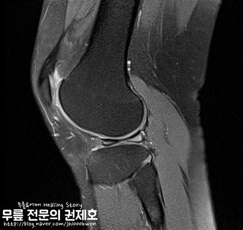 외측 반월상 연골판 파열 무릎 관절경을 이용한 연골판 부분 절제술 아전 절제술 네이버 블로그