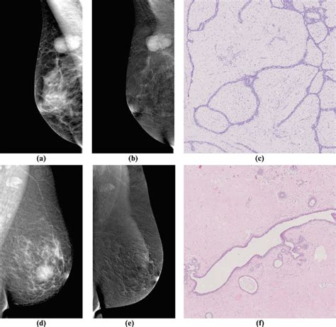 Benign Lesions With Mass Morphology A B A Circumscribed Lobular