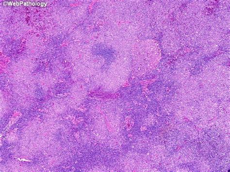 Sll In Lymph Node