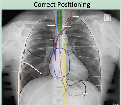 diagnostic imaging exam 1 medical device placements diagram quizlet