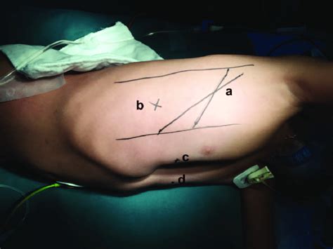 Axillary Thoracotomy
