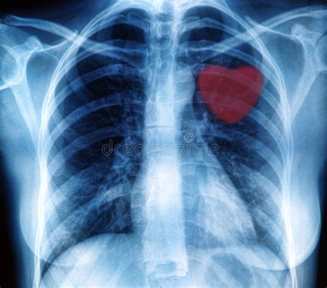 Chest X Ray Image Stock Image Image Of Heart Cardiovascular 30219627