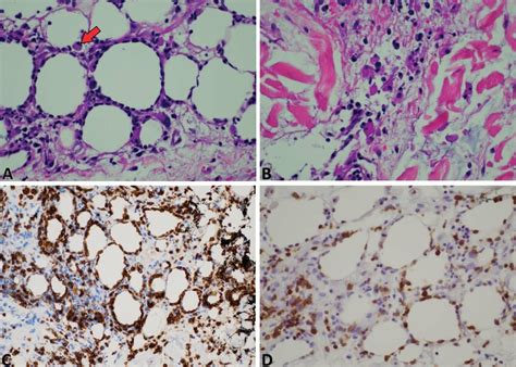 Histopathology And Immunohistochemistry Highpower Images ·400 From