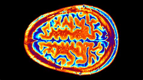 Smoothness In Parts Of Brains Surface May Boost