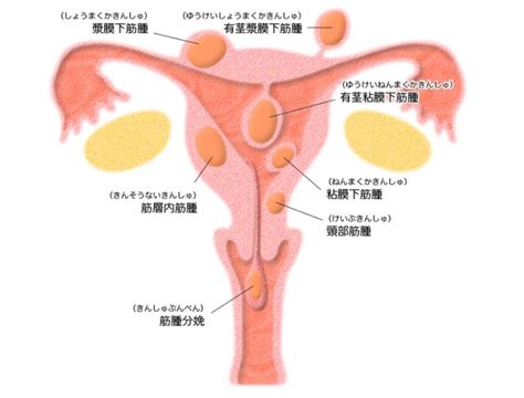 子宮筋腫名古屋の産婦人科・女性内科 パークサイド栄クリニック