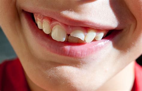 Fix Chipped Tooth Cap