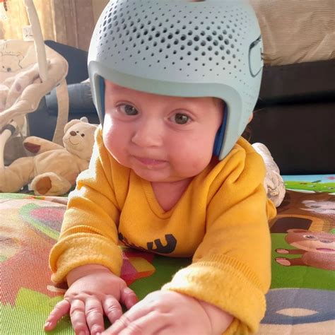 Infant Helmet Flat Head No 1 Cranial Remolding Helmet For Newborns In