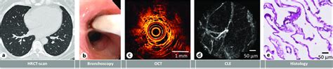Overview Of Examples Of Normal Imaging Of The Lung Parenchyma With