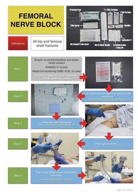 St Mungo S Fascia Iliaca Nerve Block
