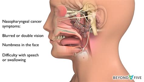 Nasopharyngeal Carcinoma Symptoms