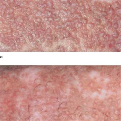 Diffuse Dermal Infiltrate Of Epithelioid Cells Macrophages Plasma