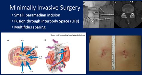 What Is Prone Transpsoas Lateral Interbody Fusion Ptp Lif