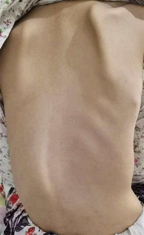 11岁女孩罕见畸形无法呼吸，医生为她“架梁”扩胸 搜狐大视野 搜狐新闻