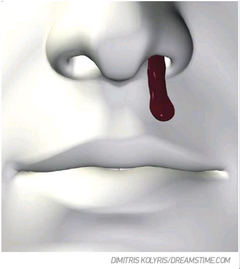 William Kimanzi On Linkedin Nose Bleeding Is A Common Emergency That