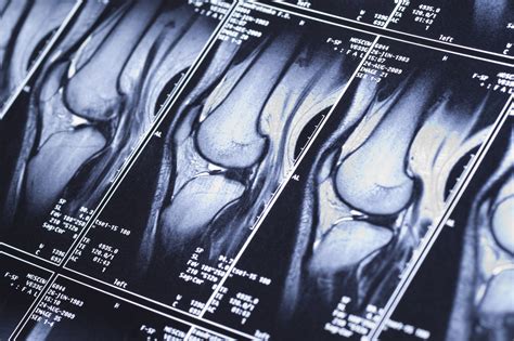 Proximal Tibial Replacement In Revision Knee Arthroplasty For Non