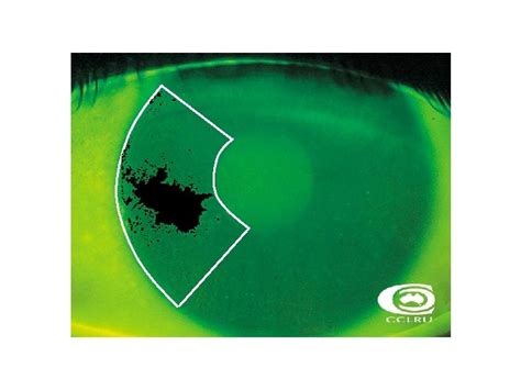 Corneal Staining Cclru Image Analysis We Fixed The