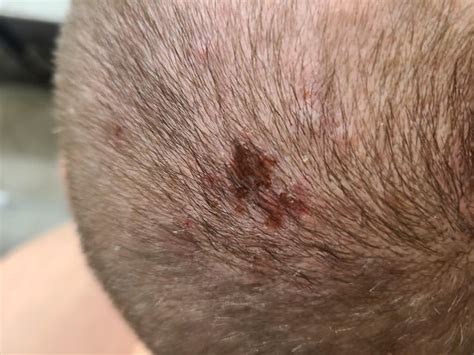 Scab From My Psoriasis Or Melanoma R Dermatology