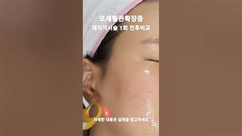 모세혈관확장증 엑셀브이 시술 더나은병원 광주레이저토닝 안면홍조 Youtube