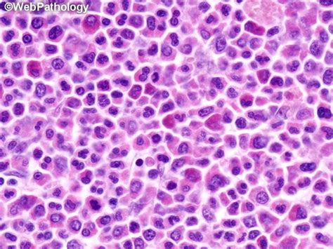 Myeloid Sarcoma Introduction