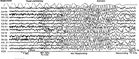 Absence Seizure Eeg