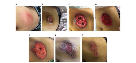 A The Patient Developed A Subcutaneous Induration In The Abdominal