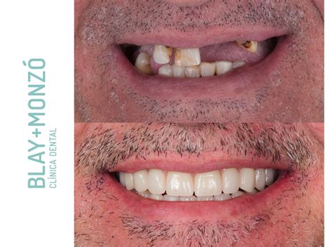 Prótesis híbrida sobre implantes dentales Clínica Dental Blay Monzo