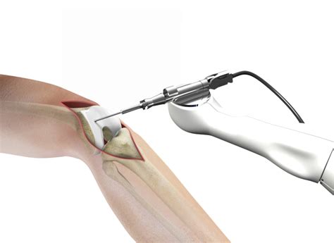 Robotic Assisted Knee Replacement Phoenix Total Knee Arthroplasty Scottsdale